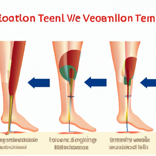 The Best Treatment Options For Venous Insufficiency In 2021 A